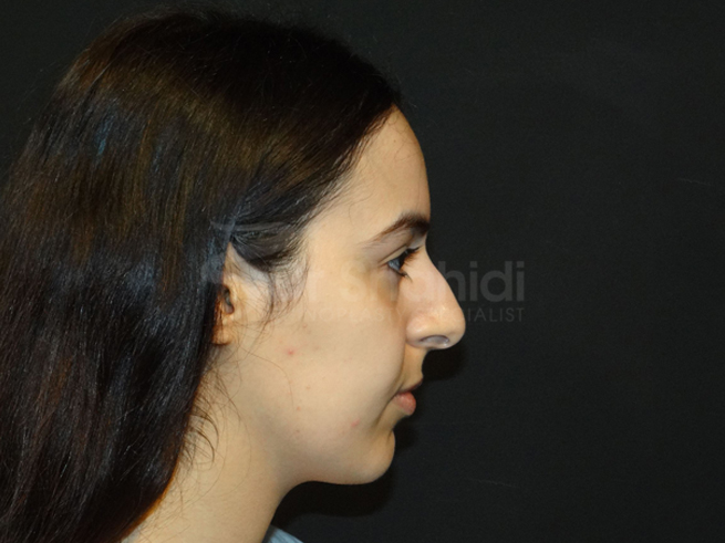 The cause for most rhinoplasties is recessed maxilla | Looksmax.org ...