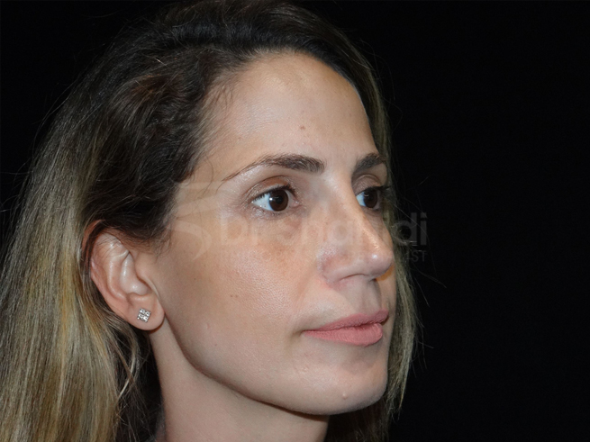 194.2 after - Dr Shahidi